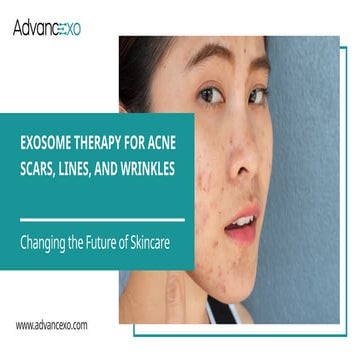 Exosome Therapy for Acne Scars, Lines, and Wrinkles | PPTX