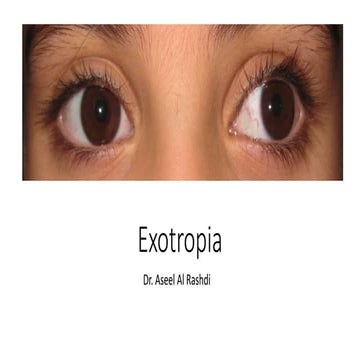 Exotropia | PPTX