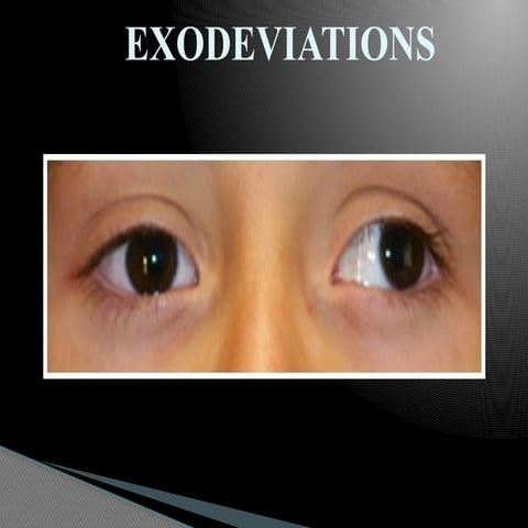 EXOtropia divergent squintv.pptx for the | PPTX