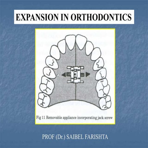 Expansion in orthodontics | PPT