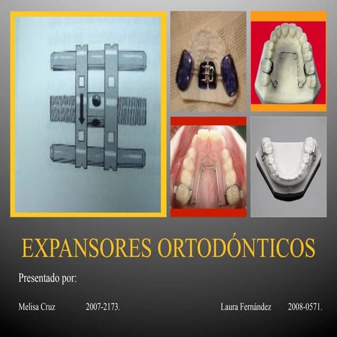 Expansores (Ortodoncia) | PDF