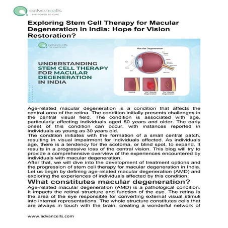 Exploring Stem Cell Therapy for Macular Degeneration in India | PDF