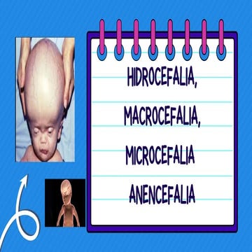 Hidrocefalia ,macrocefalia, microcefalia, | PDF