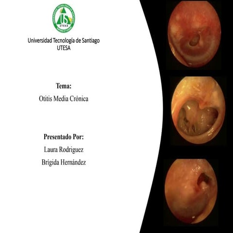 Otitis media crónica | PPTX