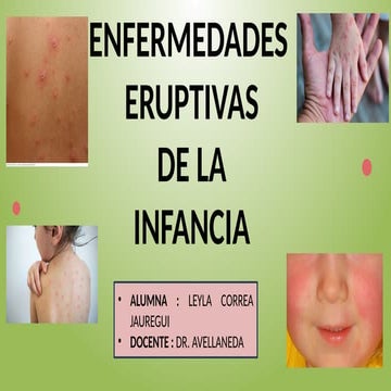 EXPOSICION ENFERMEDADES ERUPTIVAS DE LA INFANCIA - LEYLA CORREA ...