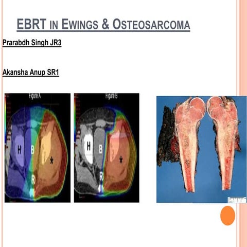Management of ewings sarcoma & osteosarcoma | PPTX
