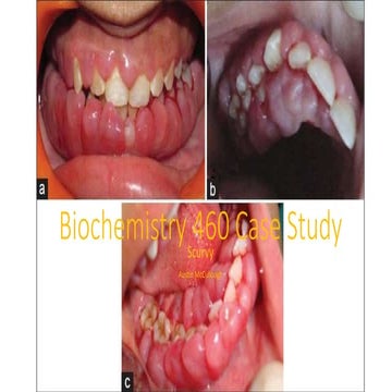 Scurvy Case Study | PPTX