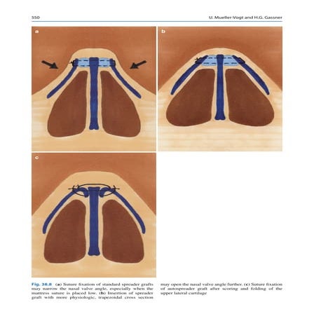 advanced aesthetic rhinoplasty best reslution | PDF | Surgery | Medical ...