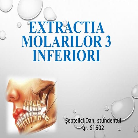 extractie-atipica....................pptx