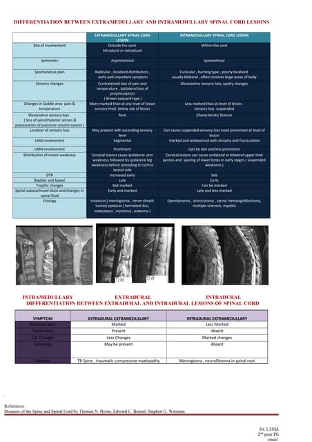 Intramedullary vs extramedullary spinal cord lesions | PPTX