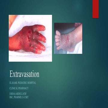 Iv Complications Extravasation