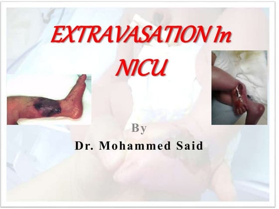 infiltration and extravasation.pptx