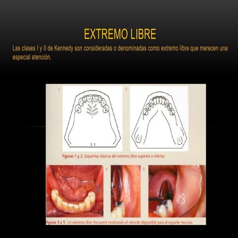 Extremo libre en PPR | PPTX