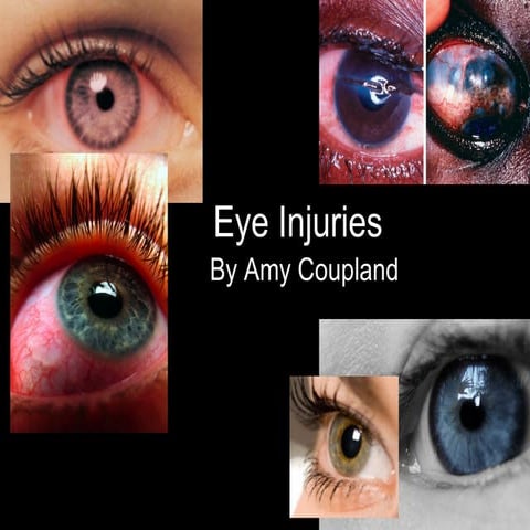 Eye Injuries | PPT