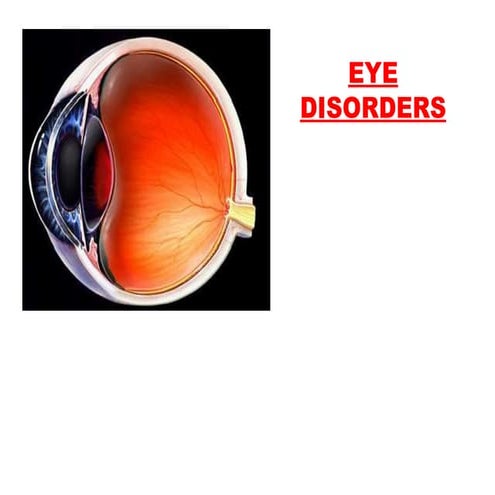 Eye Disorders and Management | PPT