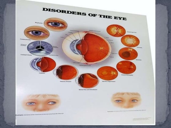 defects of eye class 10 phy | PPTX