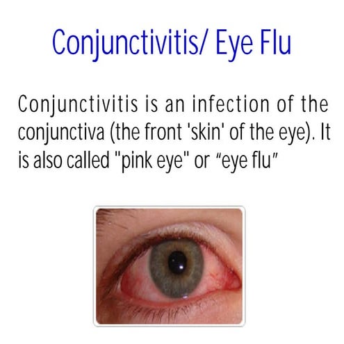 Eye flu | PDF