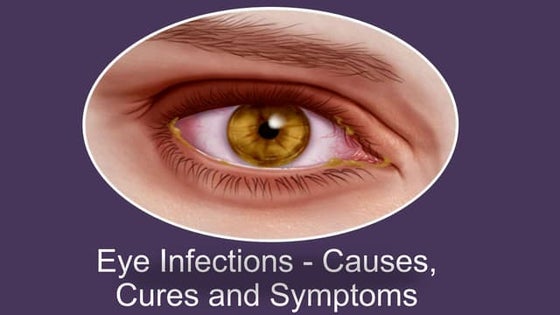 Eye Infection Symptoms You Shouldn't Ignore | PPT
