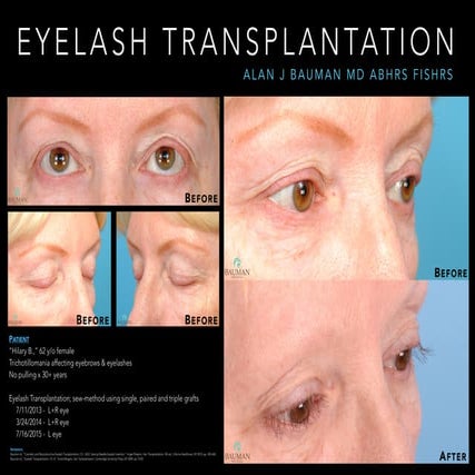 Eyelash transplant live-patient-viewing_ISHRS-2015 - Dr Alan Bauman | PDF