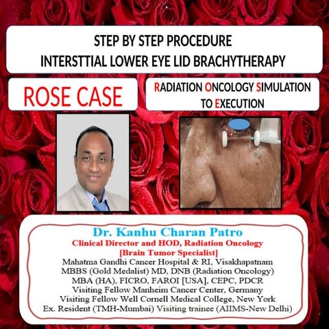EYELID BRACHYTHERAPY ROSE CASE BY DR KANHU CHARAN PATRO | PPTX