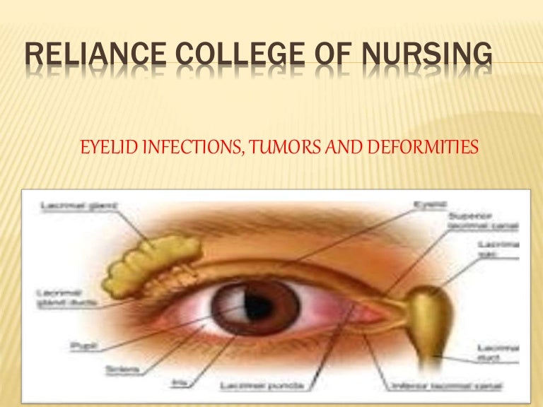 Eyelid Infection