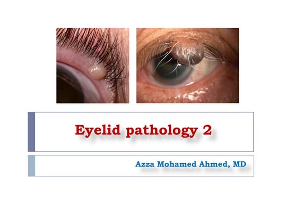 Benign Eyelid Lesions for postgraduate students | PPT | Skin and ...