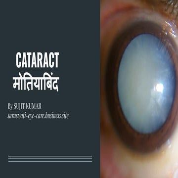 Cataract presentation | PDF