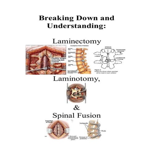 Breaking Down and Understanding Laminotomy, Laminectomy & Spinal Fusion ...