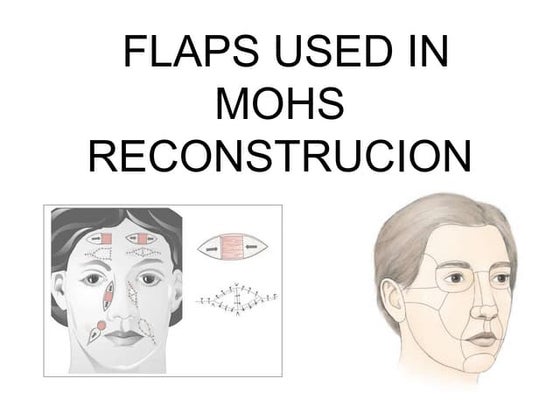 Reconstruction in head and neck surgeries | PPTX