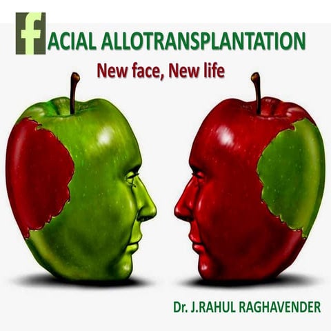 Facial allotransplantation | PPTX