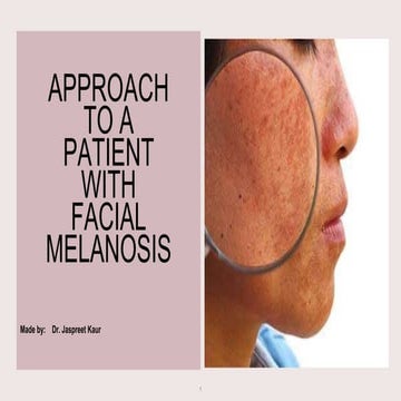 Facial Melanosis.pptx