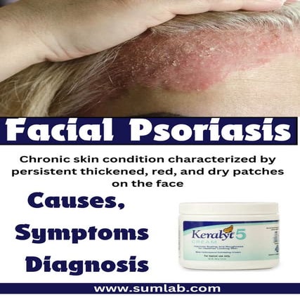What are the treatment options for facial psoriasis? | PDF