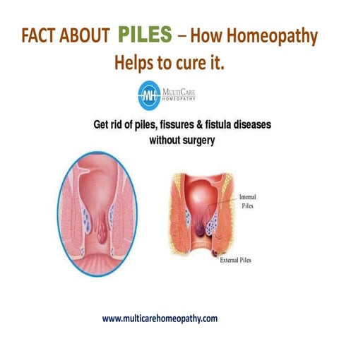 Fact about piles how homeopathy helps to cure it | PPT