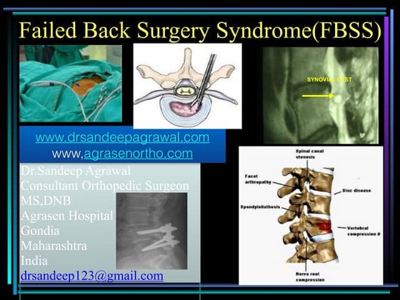 Failed Back Surgery Syndrome | PPT