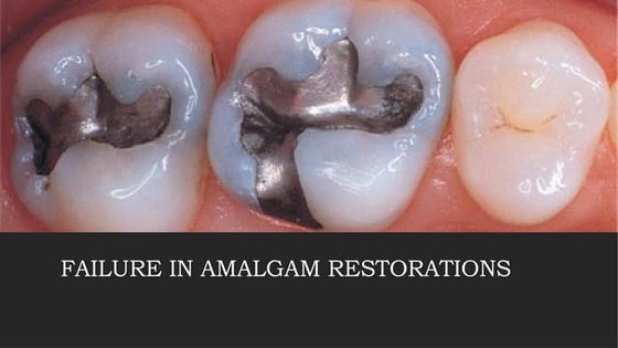 Bevels in Dental Restorations | PPTX | Dental Health | Diseases and ...