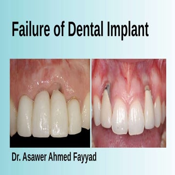Failure of dental implant...........pptx