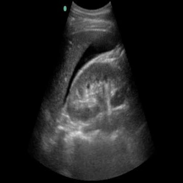 FAST scan in STABLE BLUNT TRAUMA patients | PPTX