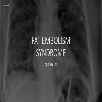 fat Embolism jsjsjakakakksjdhdhdhbdjdjdjdjdjjd | PPT