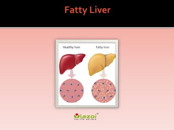 Fatty liver biochemistry by Dr. Anurag Yadav | PDF | Chemistry | Science