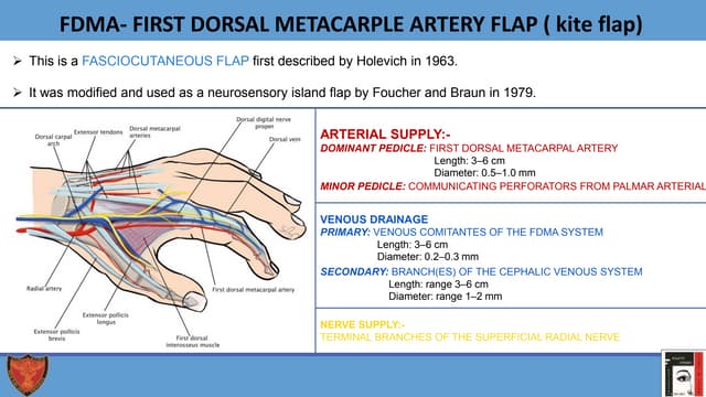 V-Y Advancement flap - for Fingertip amputations | PPTX