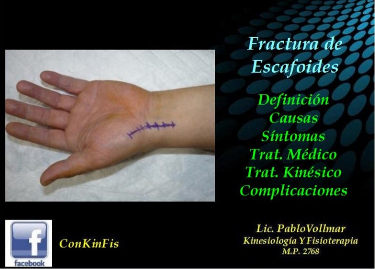 Fractura Del Escafoides