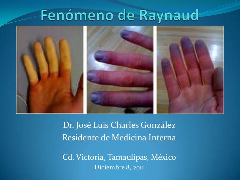 Fenomeno de Raynaud