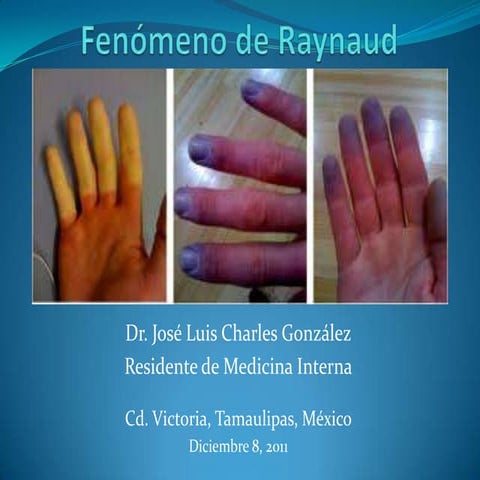 Fenomeno de Raynaud | PPTX