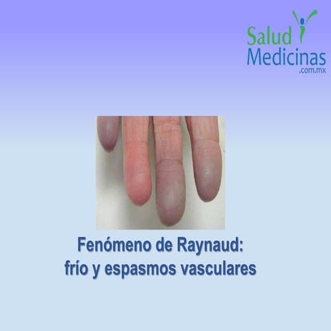 Síndrome de raynaud | PPT