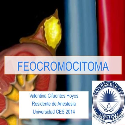 Feocromocitoma valen | PPTX