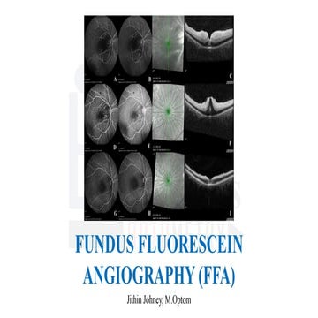 FUNDUS FLUORESCEIN ANGIOGRAPHY-FFA BY OPTOM. JITHIN JOHNEY | PDF