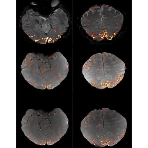Lung imaging Using 3D Dual-Echo FID Ultra-short Echo Time MRI with ...