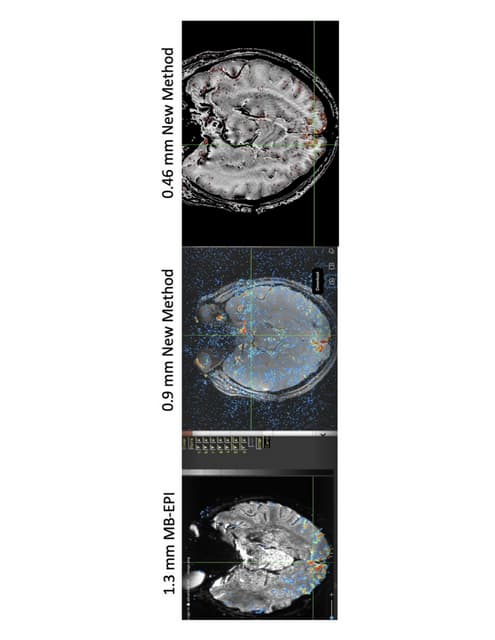 Quantitative Susceptibility Mapping (QSM) Using High-resolution Ultra ...