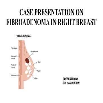 FIBROADENOMA IN RIGHT BREAST. Present by Dr Nasir Uddin | PDF