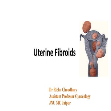 Uterine fibroids | PPTX